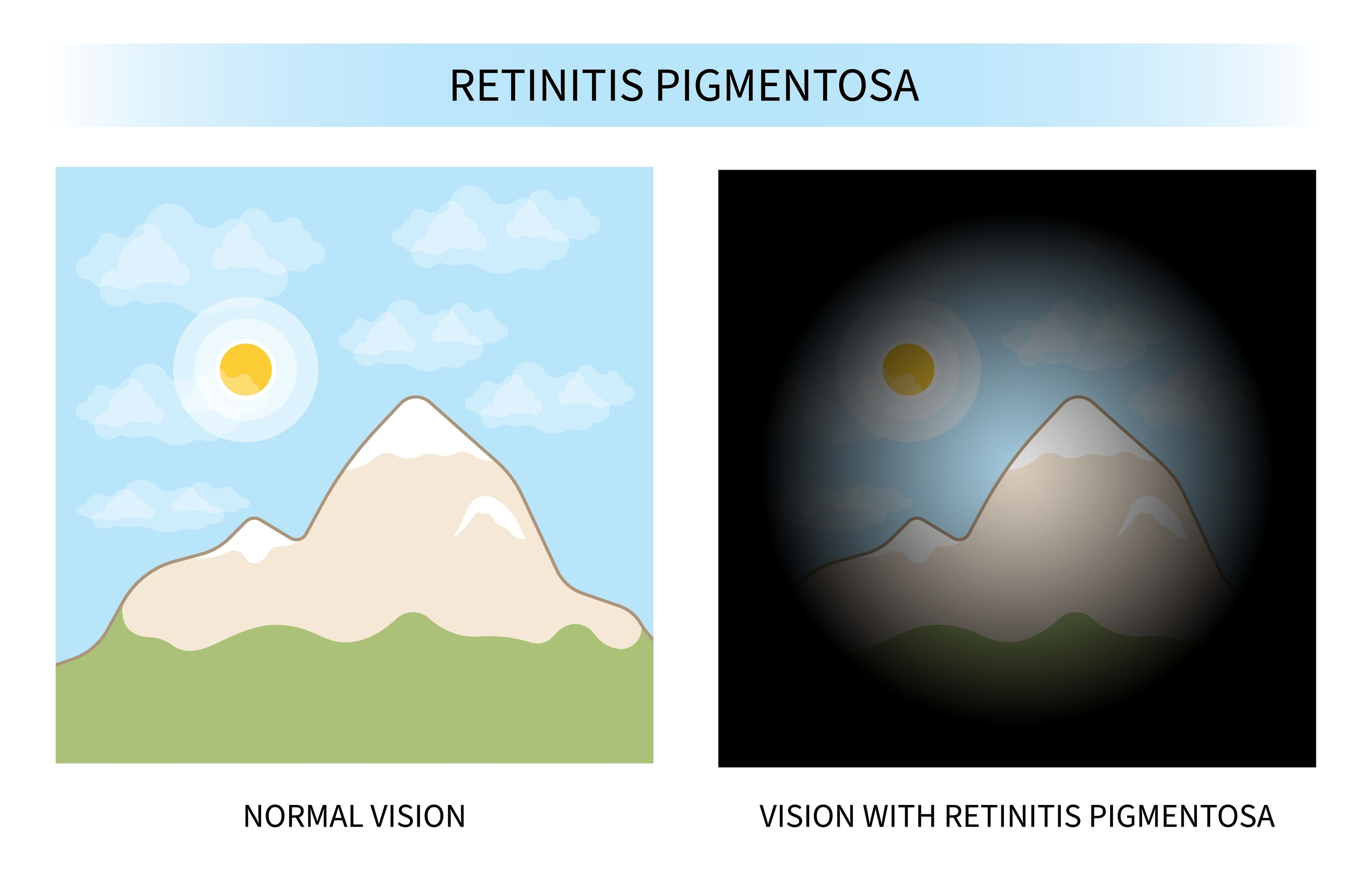 What is Retinitis Pigmentosa?